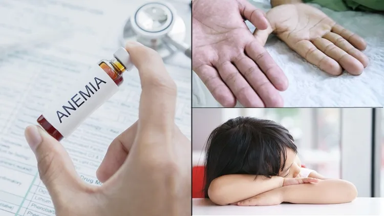 Macam-macam Gejala Anemia, Demen Ngunyah Es Batu Salah Satunya. Kamunya ...